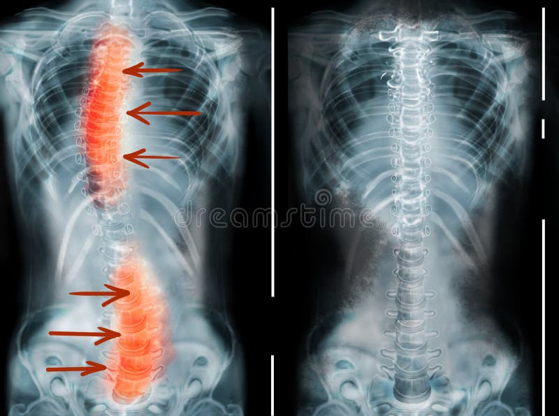 X-rays of Human Normal and Curved Spines. Patient Suffering from ...
