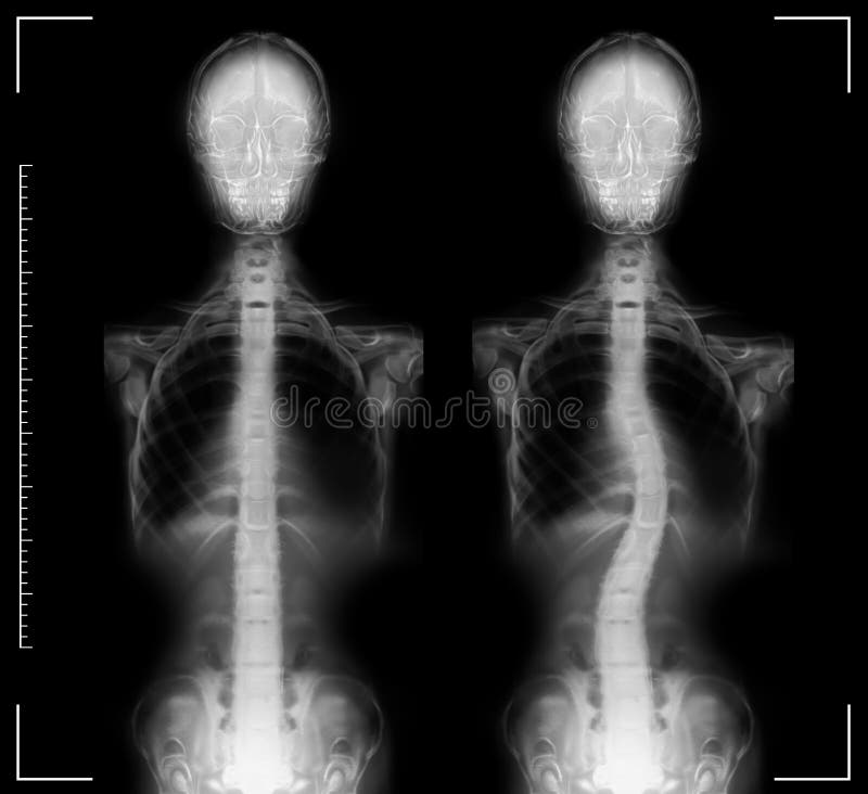 X-rays of Human Normal and Curved Spines. Patient Suffering from ...