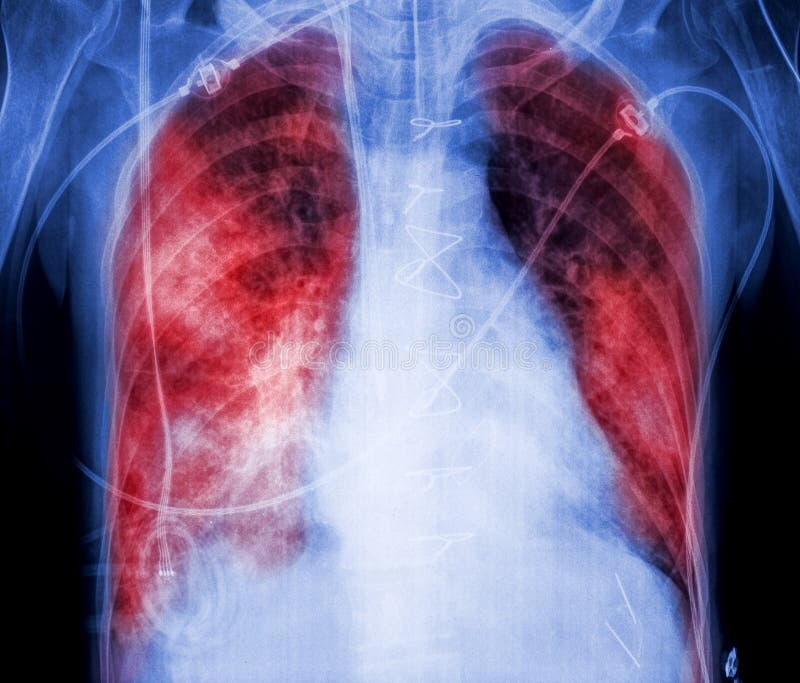 X-rays with Lungs Marked Red Color Stock Illustration - Illustration of ...
