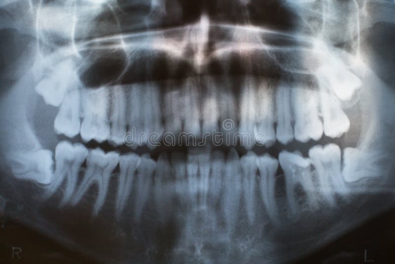 Child Skull Teeth Xray Stock Photos - Free & Royalty-Free Stock Photos ...