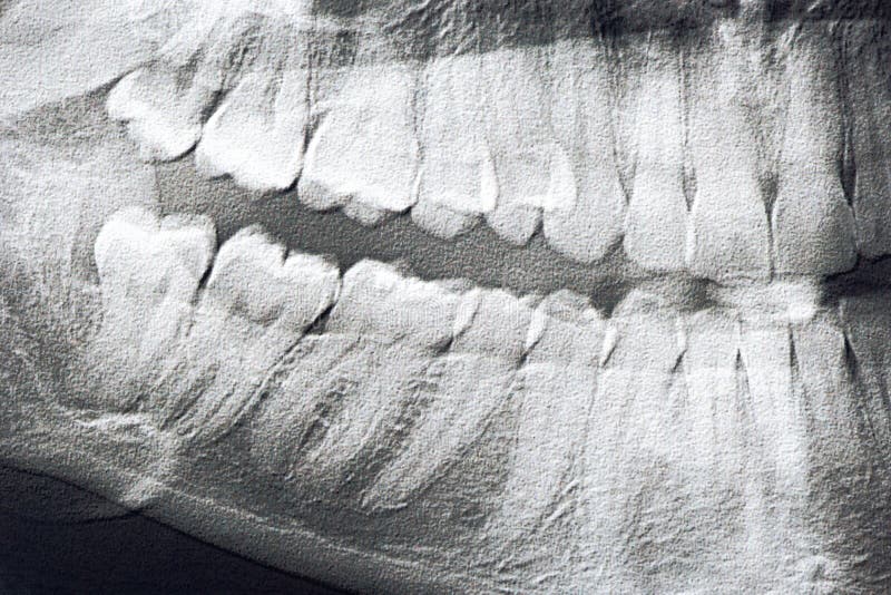 X-rays teeth stock image. Image of dentist, radiation - 91438431