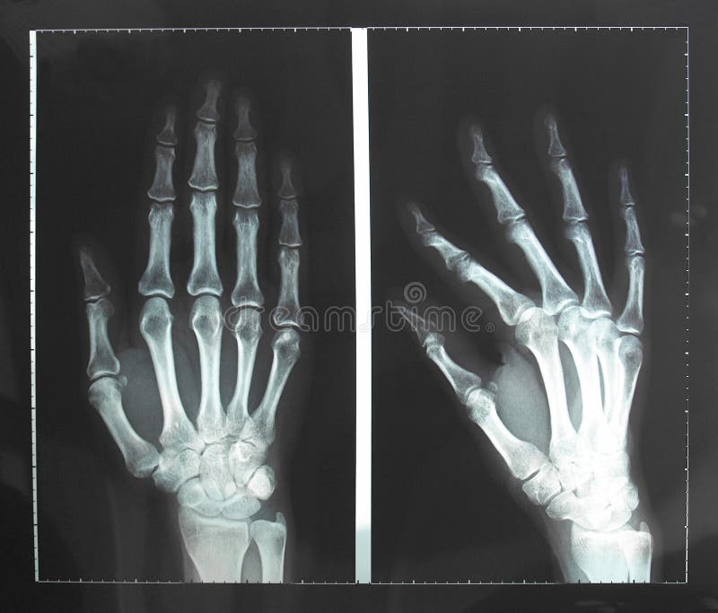 Xray stock image. Image of imaging, xray, medicine, bone - 10989731