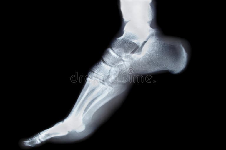 208 Xray Ankle Toes Stock Photos - Free & Royalty-Free Stock Photos ...