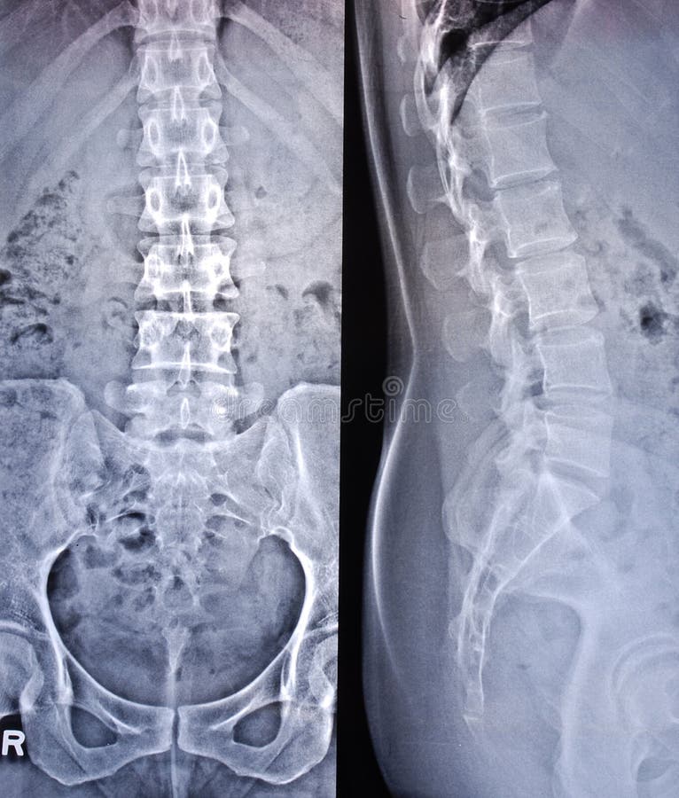 CT of Lumbar Spine stock photo. Image of bones, fracture - 9982766