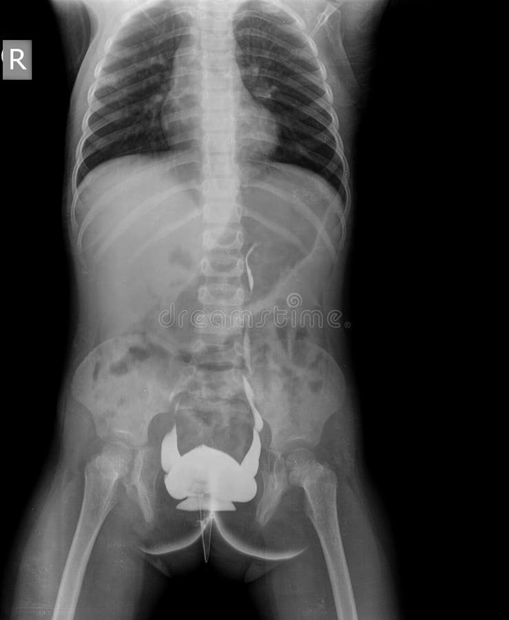Cat XRay Abdomen with Bowel Obstruction Stock Photo - Image of texture ...