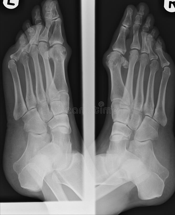 Bruises, Bunions, Broken Toes Stock Image - Image of aging, abnormality ...