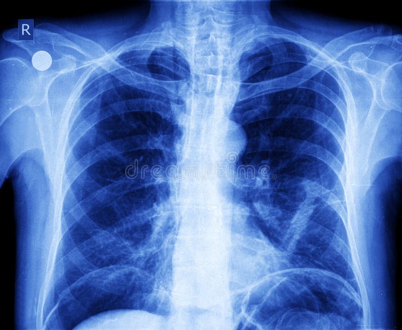 Xray Chest Negative stock image. Image of body, radiologist - 1400899