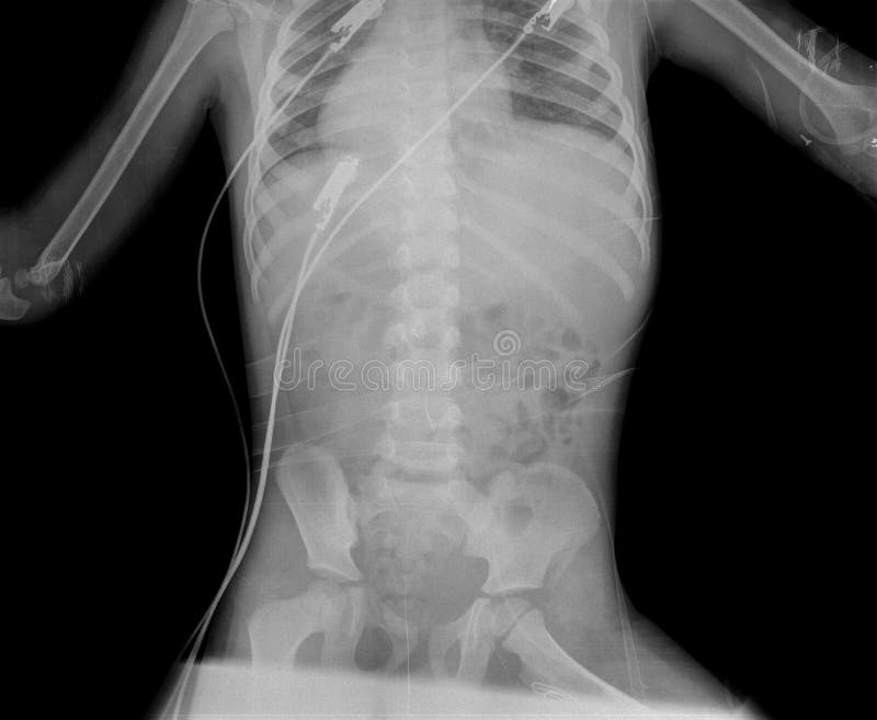 175 Chest Ray Human Child Stock Photos - Free & Royalty-Free Stock ...