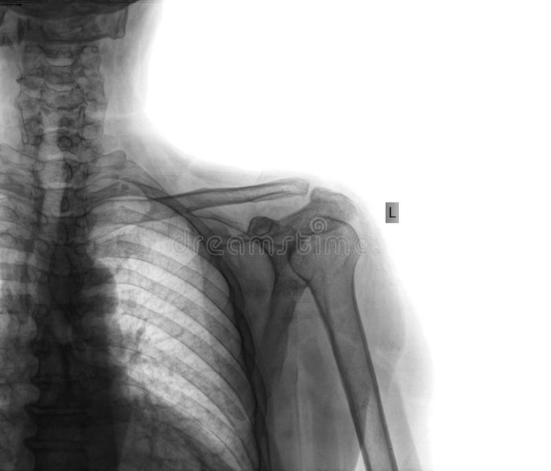 Xray chest stock photo. Image of anesthesia, healthcare - 47702384