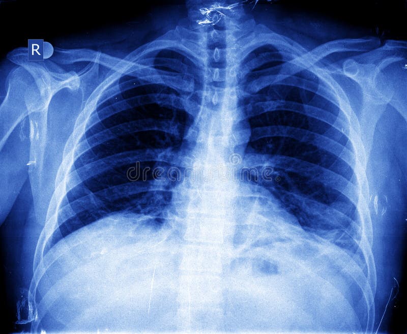 Xray chest stock photo. Image of equipment, breathing - 47703442