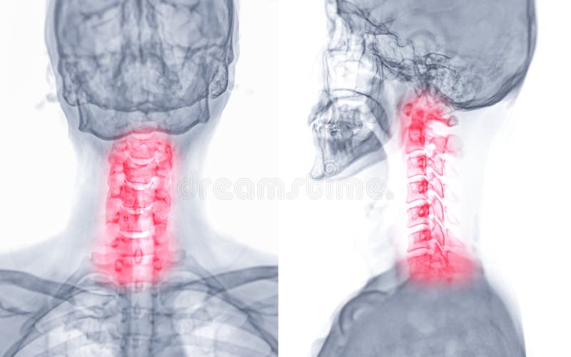 Xray Cspine Ou Xray Image of Cervical Spine Ap and Lateral View for ...