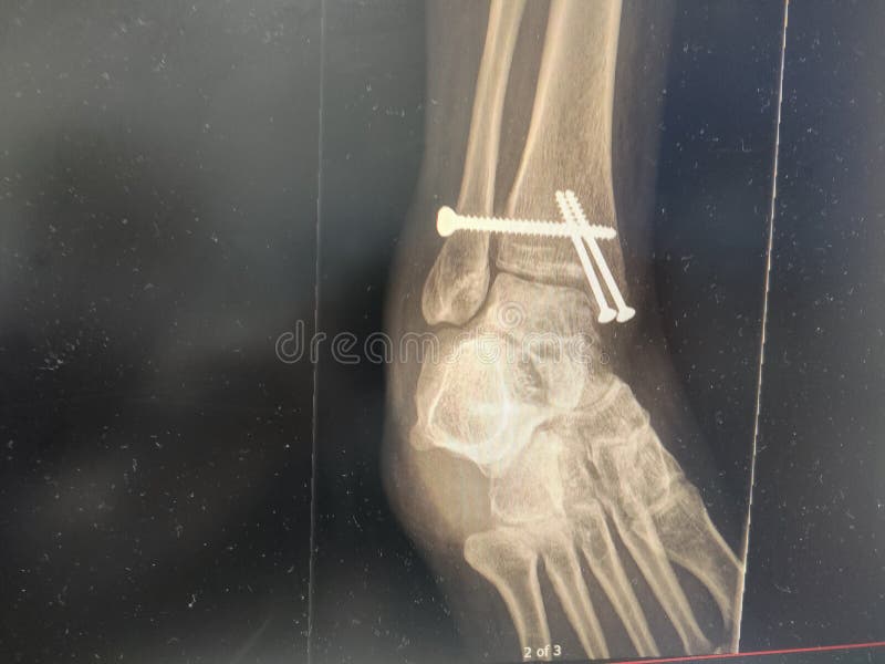 Xray de tibia roto foto de archivo. Imagen de oscuridad - 236506884