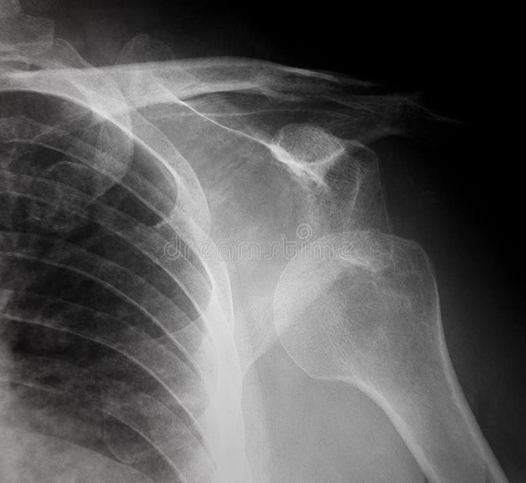 Sport Injury- Plain Film X-ray, Radiography of Dislocated Shoulder ...