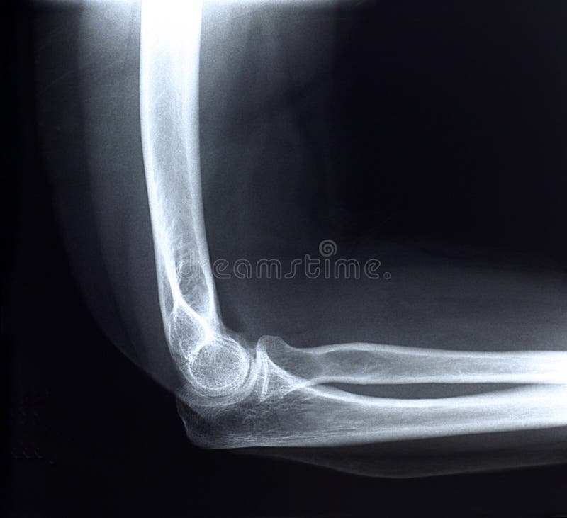 Xray/Elbow side stock photo. Image of fracture, nurse, internal - 198826