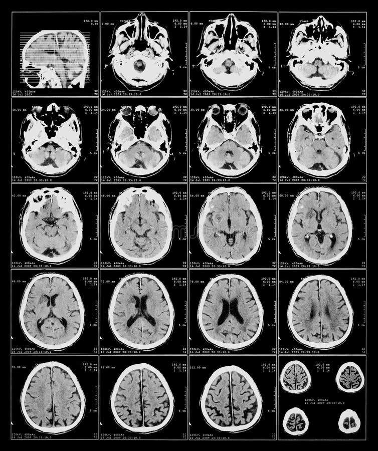 Xray film of the brain stock photo. Image of medicine - 183512858