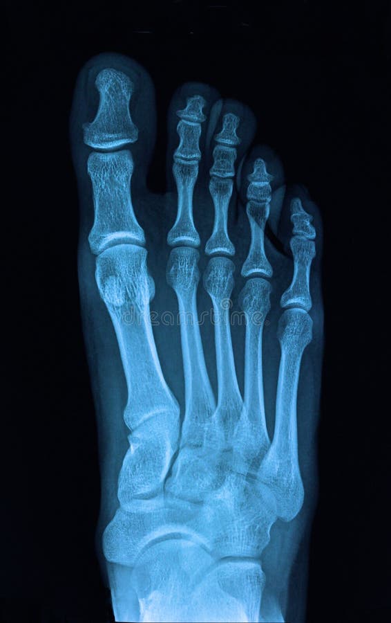 Foot x-ray stock image. Image of skeletal, surgery, test - 29740005