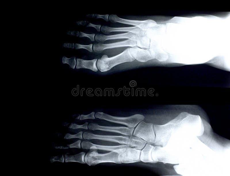 Xray/Foot front stock image. Image of feet, foot, clinic - 198833