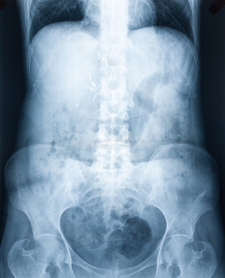 Xray of a human abdomen stock image. Image of diagnostic - 38958345