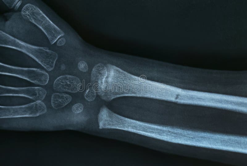 X Ray Broken Hand