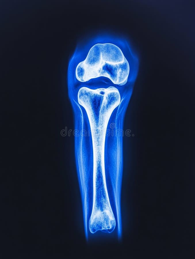 Xray Image of a Human Knee Joint this Image Shows a Detailed Xray View ...