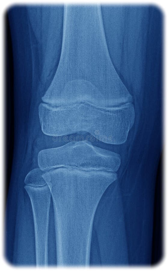 Xray of the knee stock illustration. Illustration of radiography - 43346392