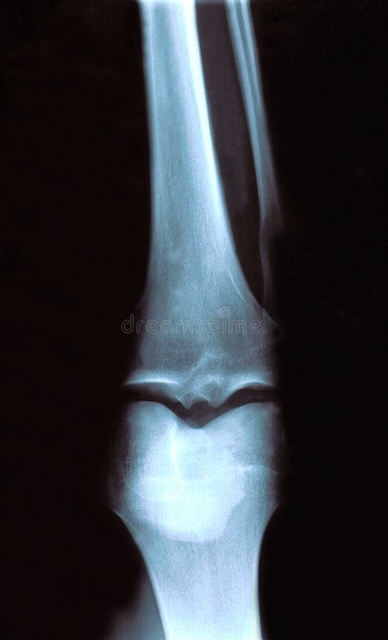 Xray of a Knee - Front View Stock Photo - Image of internal, ligament ...