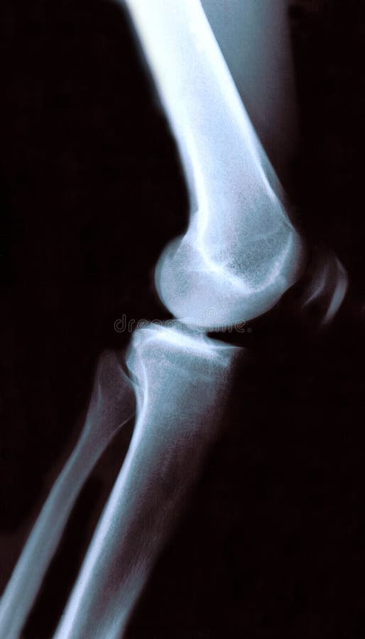 Xray of a Knee - side view stock image. Image of life - 8019533