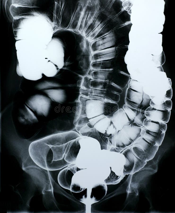 Cast stock image. Image of broken, painful, injury, bone - 71197