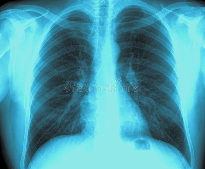 Xray lung stock photo. Image of lung, diagnostic, anatomy - 31070096