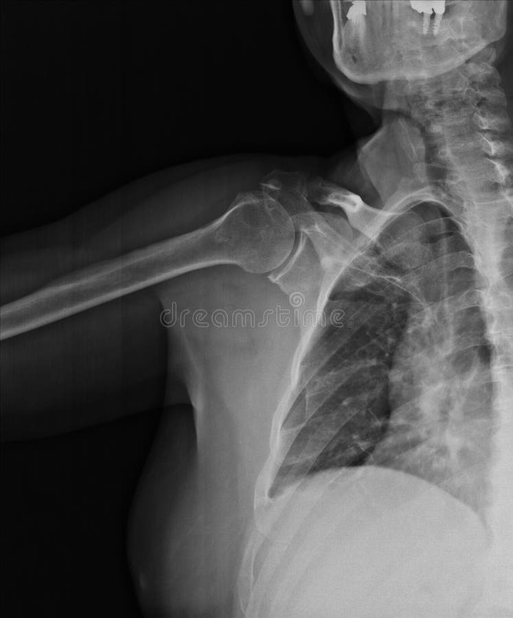 Xray of shoulder stock photo. Image of xray, adult, bone - 39971498