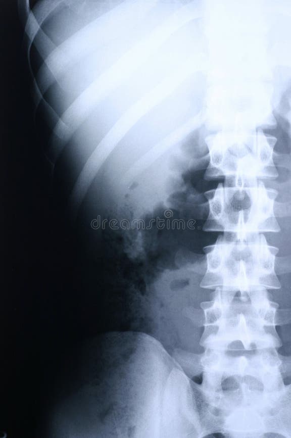 647 Broken Spine Xray Stock Photos - Free & Royalty-Free Stock Photos ...