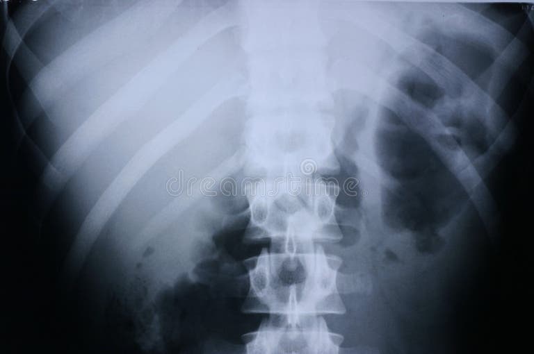 1,122 Lung Spine Thermography Stock Photos - Free & Royalty-Free Stock ...