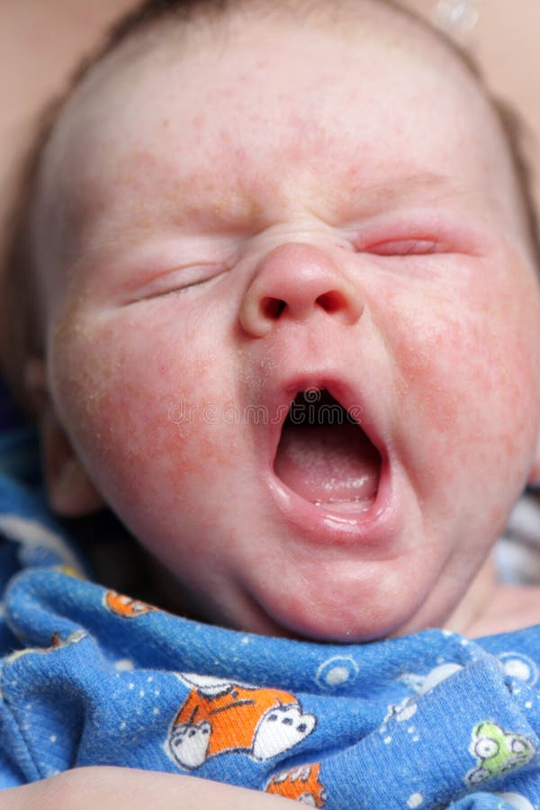Baby With Allergic Diathesis Stock Image - Image of little, caucasian ...