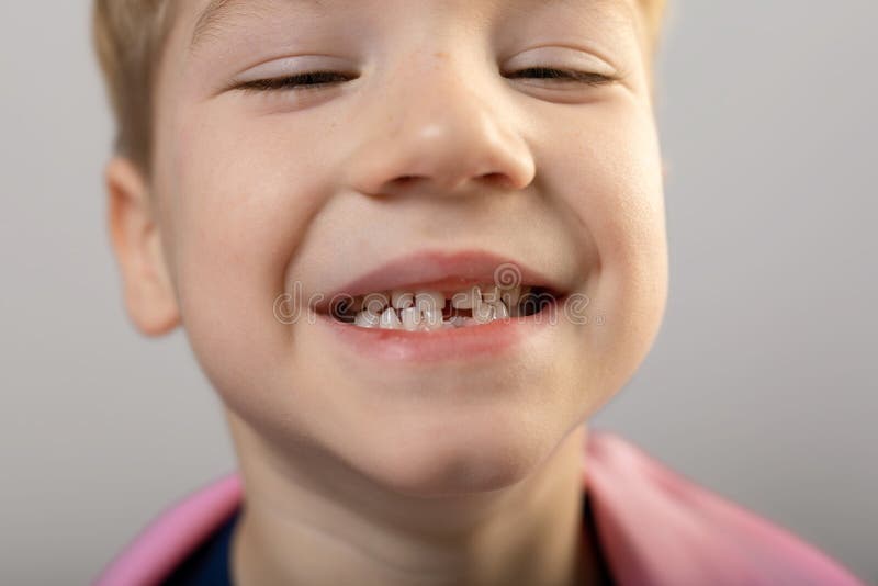 5 Year Old Boy Shows First Fallen Milk Tooth. Smiling Five-year-old Boy ...