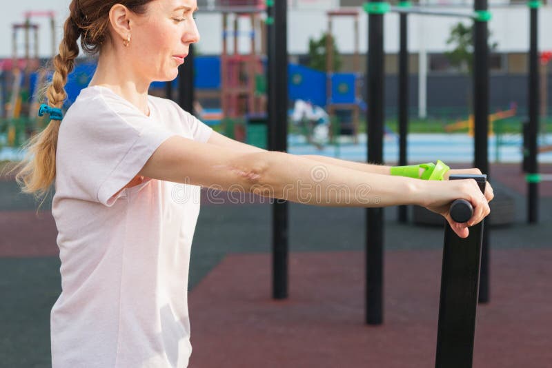 38years Woman Recovery after Trauma Broken Arm Stock Photo - Image of ...