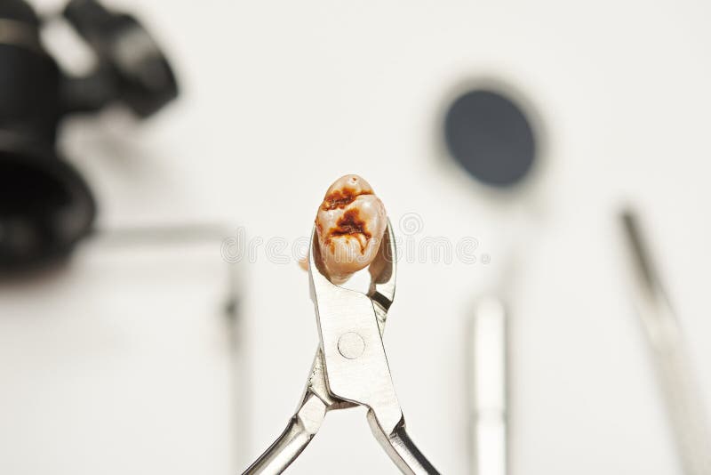 Yellow Damaged Cavity Teeth Stock Photo - Image of brush, extracted ...