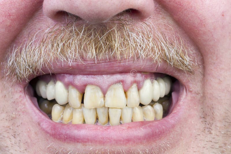 Yellow Teeth Are Sick Studio Shot Stock Image - Image of mouth, cracked ...