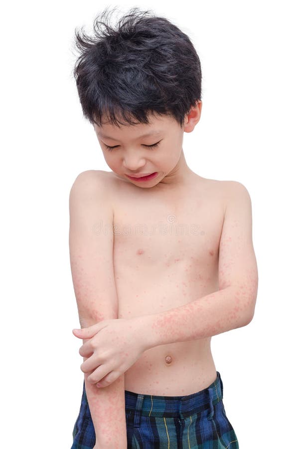Child Arm Skin Rash Over White Stock Photos - Free & Royalty-Free Stock ...