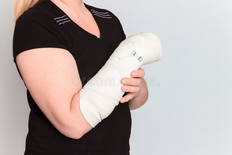 Young Female with Broken Hand in Cast Stock Image - Image of injury ...