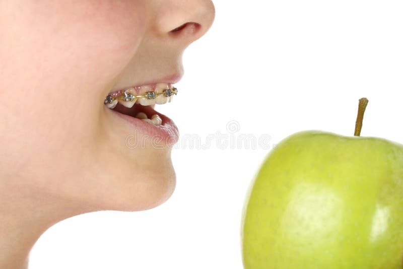 Girl with braces and apple stock photo. Image of cleaning - 139099882