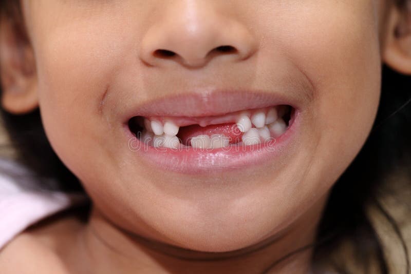 Young Girl with Missing Front Tooth Stock Photo - Image of race, little ...