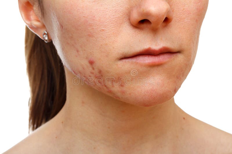 Skin problem of woman face stock photo. Image of adult - 85674132