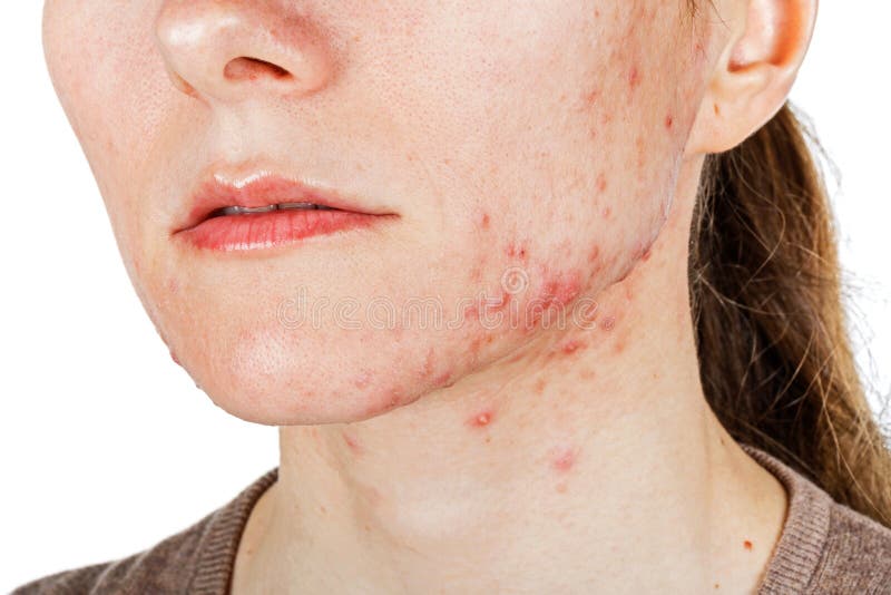 Young Girl with Skin Problem Stock Image - Image of blemishes, hair ...