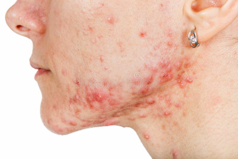 Young Girl with Skin Problem Stock Photo - Image of dermatology ...