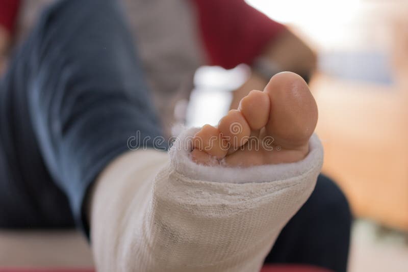 Young Man with a Broken Ankle and a Leg Cast Stock Photo - Image of ...