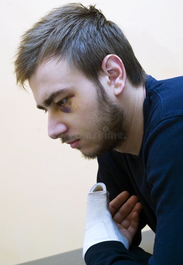 Young man with bruise stock image. Image of injury, facial - 60837177