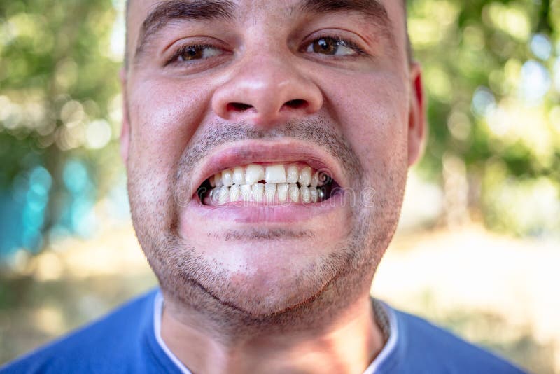 Young Man with a Chipped Tooth Stock Photo - Image of hygiene, laugh ...