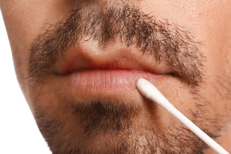 Man Cold Sore Applying Cream Lips Against White Background Closeup ...