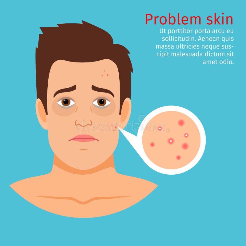 Young Man Face Problem Skin Acne Stock Vector - Illustration of ...