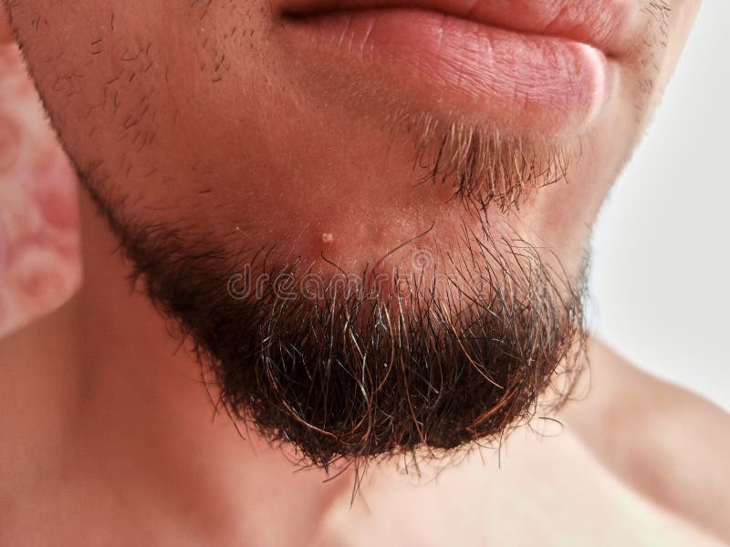 A Young Man with a Pimple in His Beard Stock Image - Image of facial ...